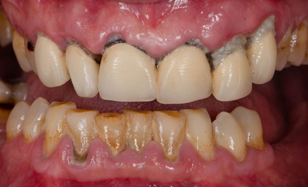 What is a gum pocket? - Al-Fa Perio