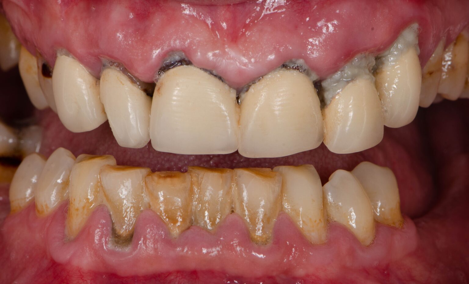 What is a gum pocket? - Al-Fa Perio